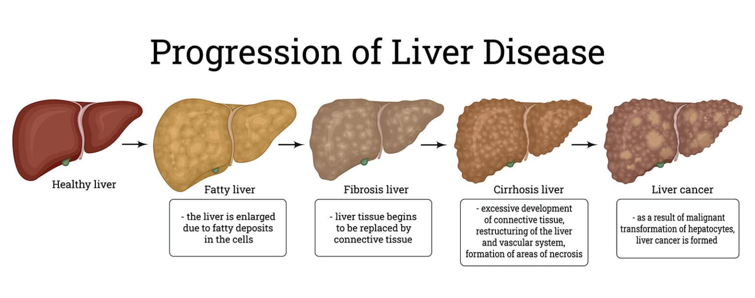 Signs Your Liver Is Healing - Long Island Interventions